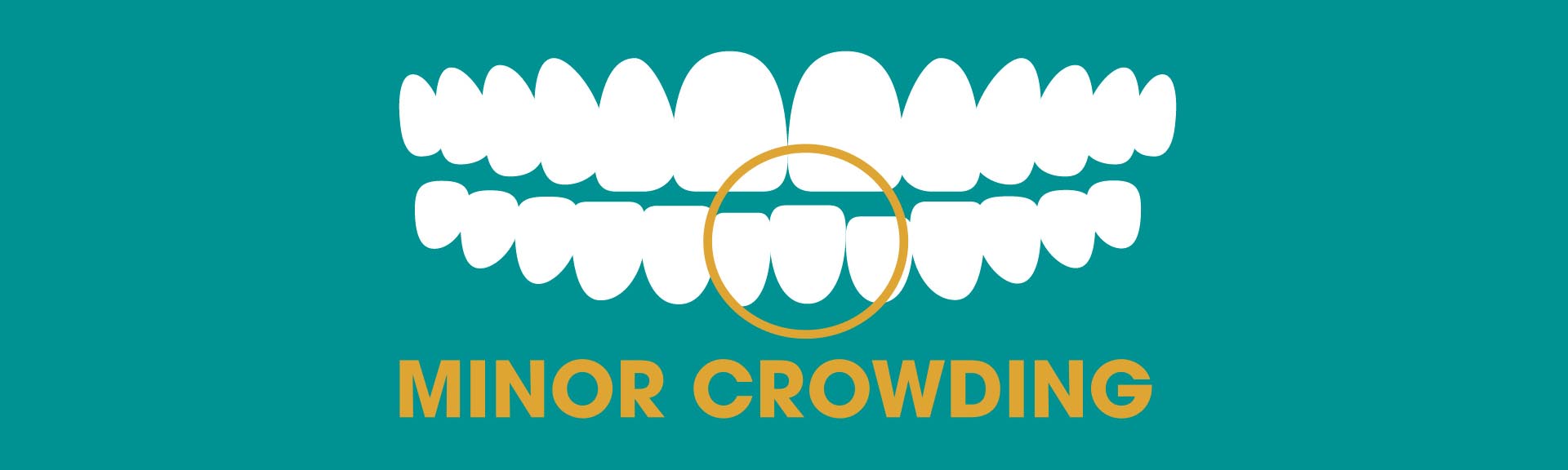 Designing Your Custom Smile with Dental Veneers - Meyerwood Dentistry